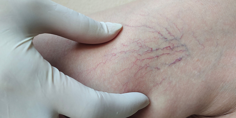 Vein Disease Warning Signs: Why Your Legs Ache & How to Act